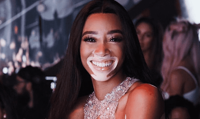 Instagram: Modelo con vitíligo fue elegida para el Victoria’s Secret ...